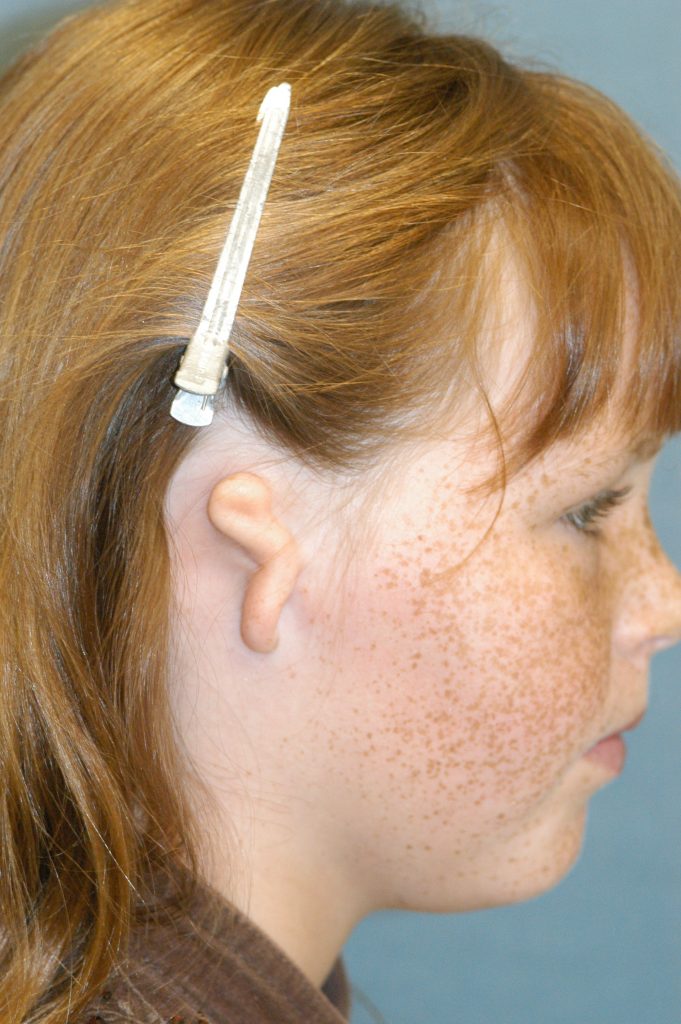 Microtia (Outer ear reconstruction) - Zeph Cosmetic Surgery, Camel ...